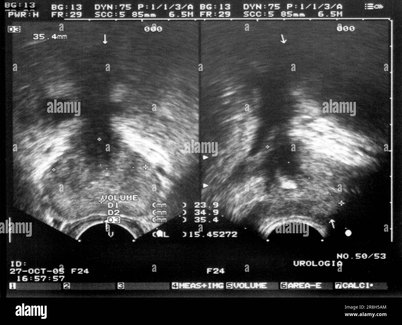 Prostate Anatomy Ultrasound