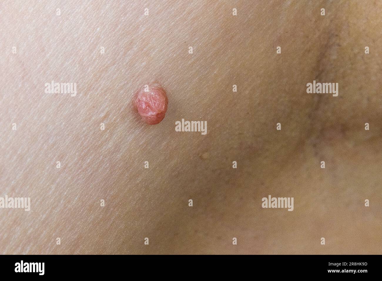 Skin mole hi-res stock photography and images - Alamy