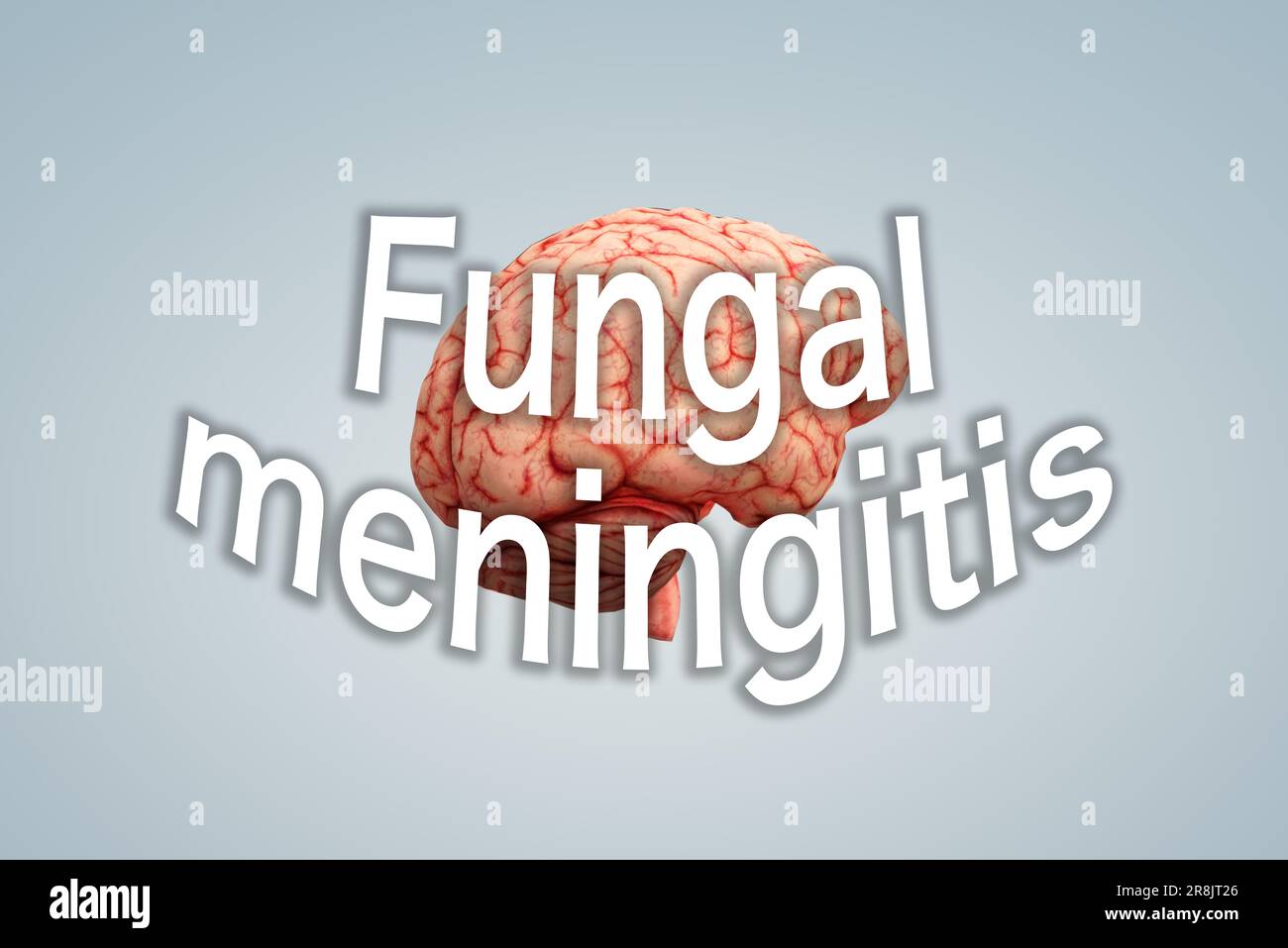 Fungal Meningitis Symptoms