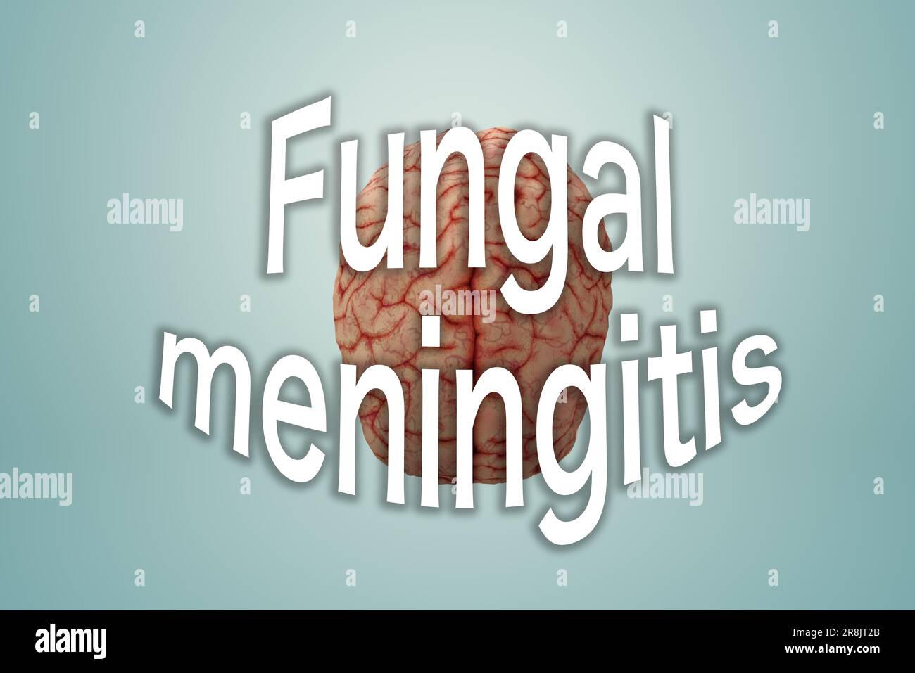 Fungal Meningitis Symptoms