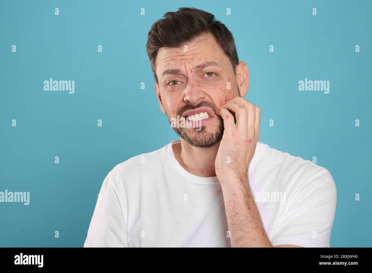 Man with rash suffering from monkeypox virus on light blue background ...