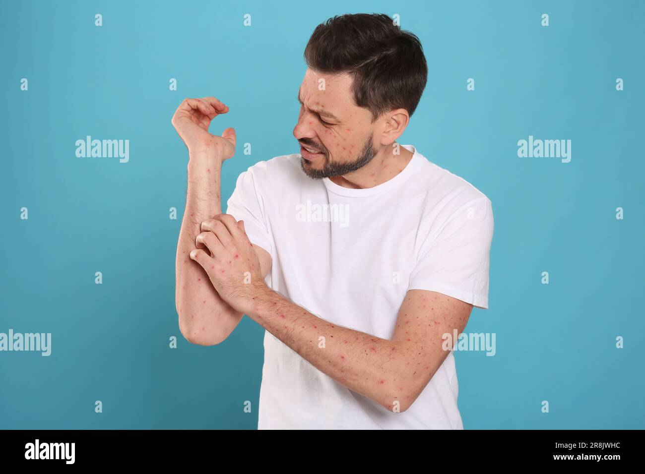 Man with rash suffering from monkeypox virus on light blue background ...