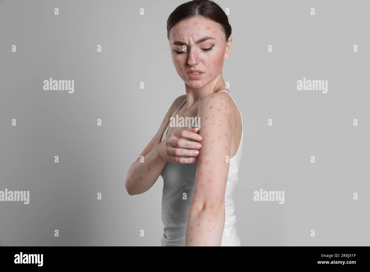 Woman with rash suffering from monkeypox virus on light grey background ...