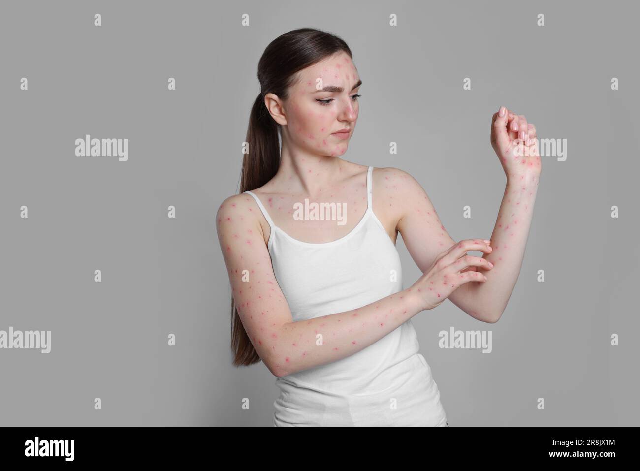 Woman with rash suffering from monkeypox virus on light grey background ...