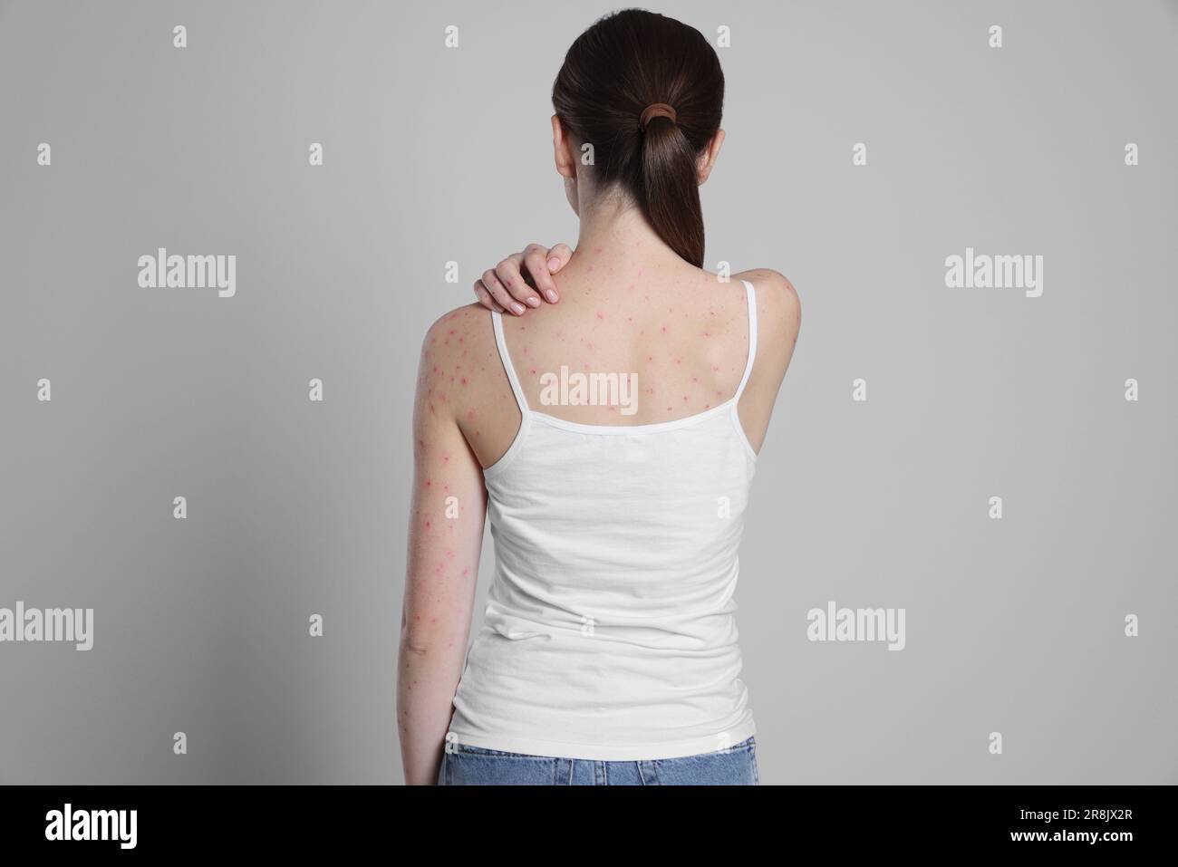 Woman with rash suffering from monkeypox virus on light grey background ...