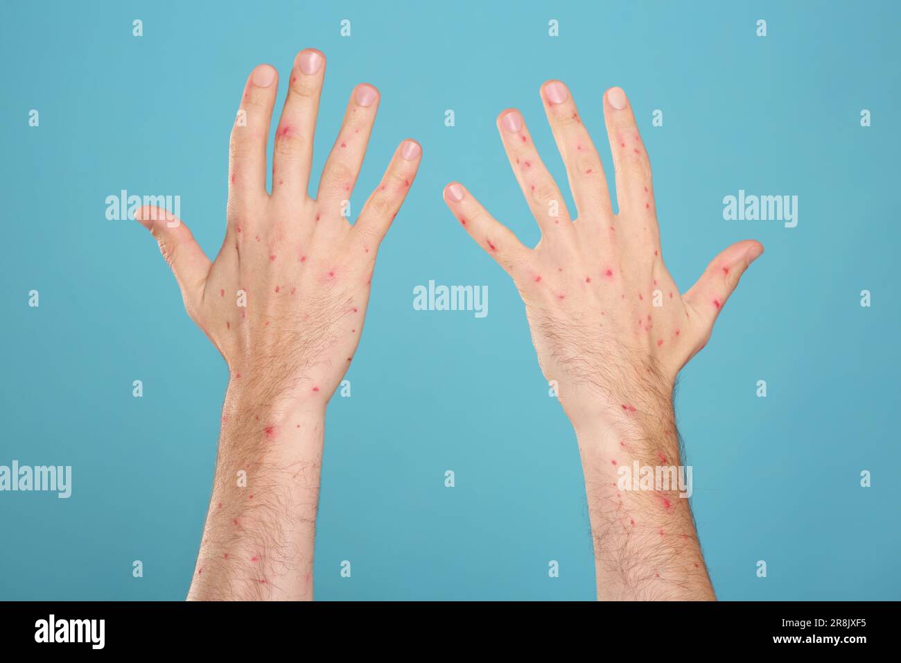 Man with rash suffering from monkeypox virus on light blue background ...
