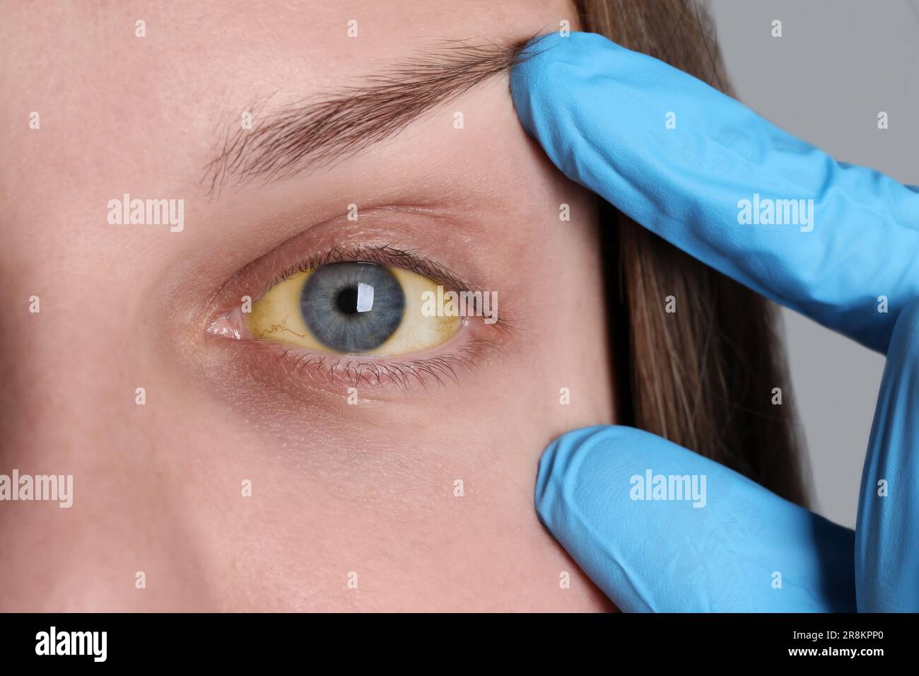 Doctor checking woman with yellow eyes on light background, closeup ...