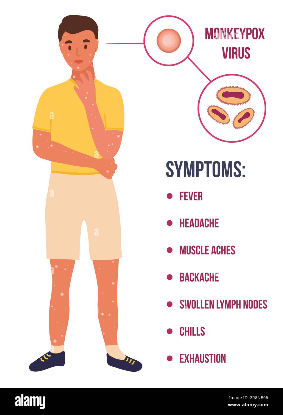 young caucasian man with many papules because of Monkey Pox virus ...