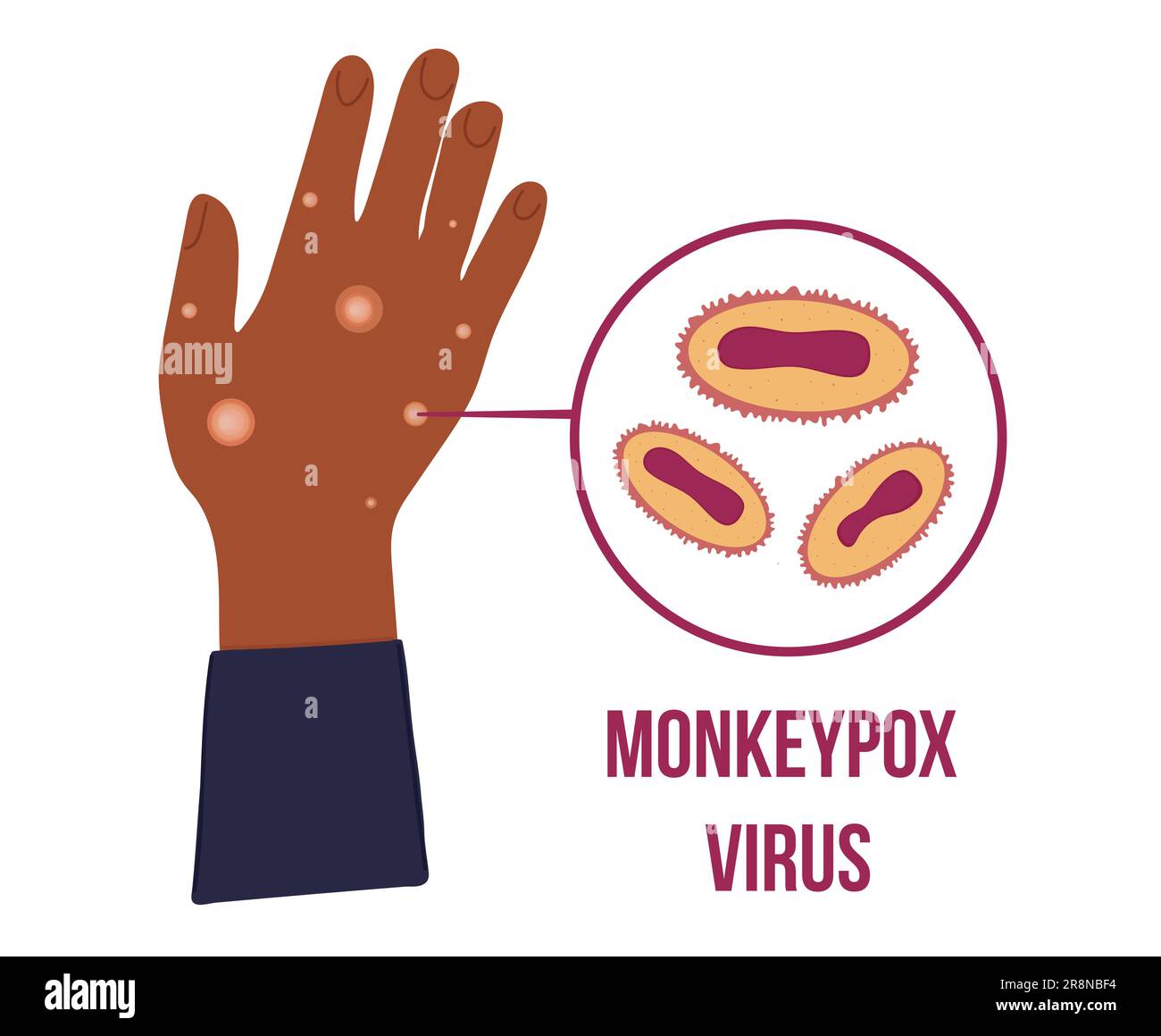 Hand drawn black African hand with many papule because of Monkey Pox ...