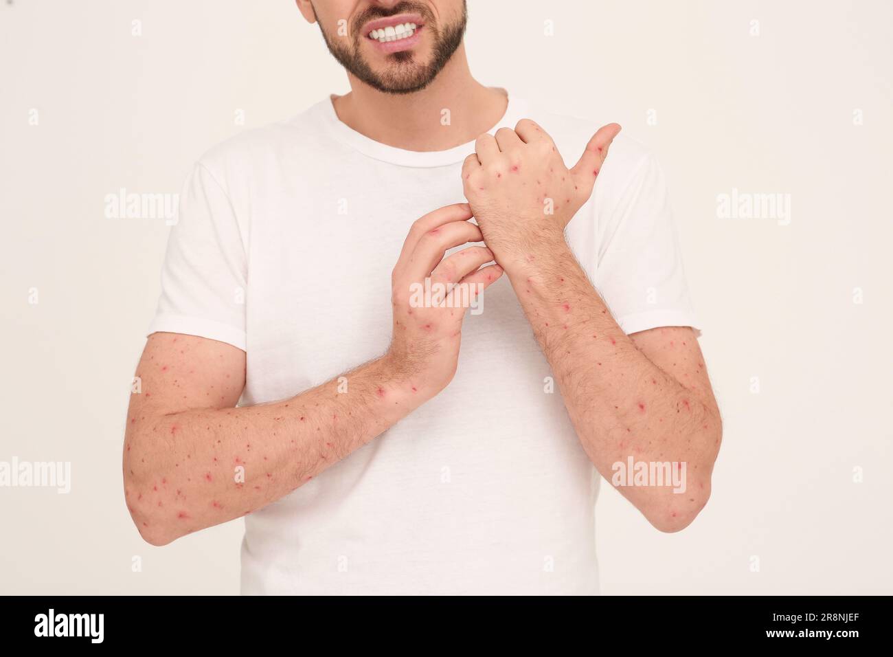 Man with rash suffering from monkeypox virus on beige background ...