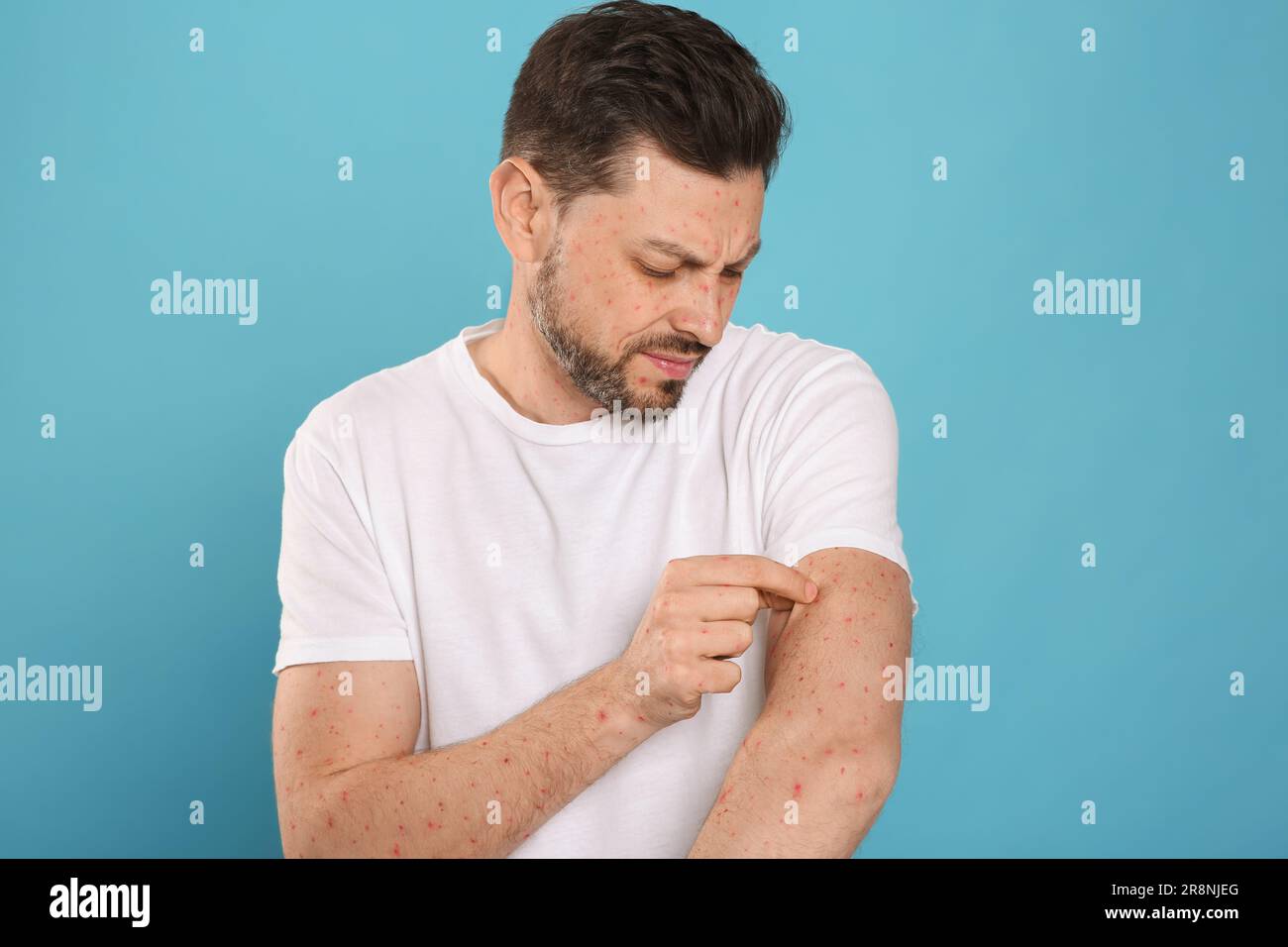 Man with rash suffering from monkeypox virus on light blue background ...