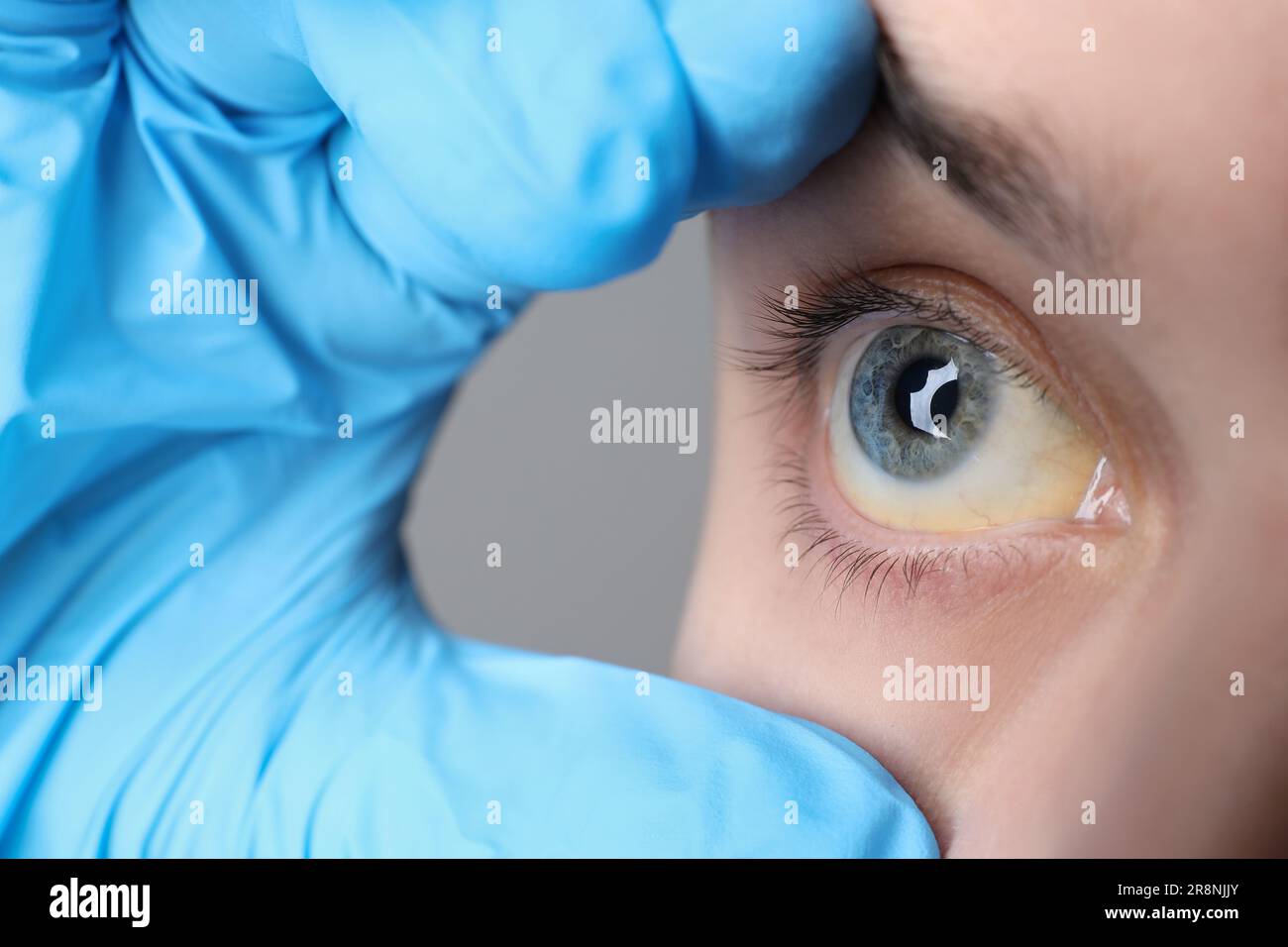 Doctor checking woman with yellow eyes on grey background, closeup ...