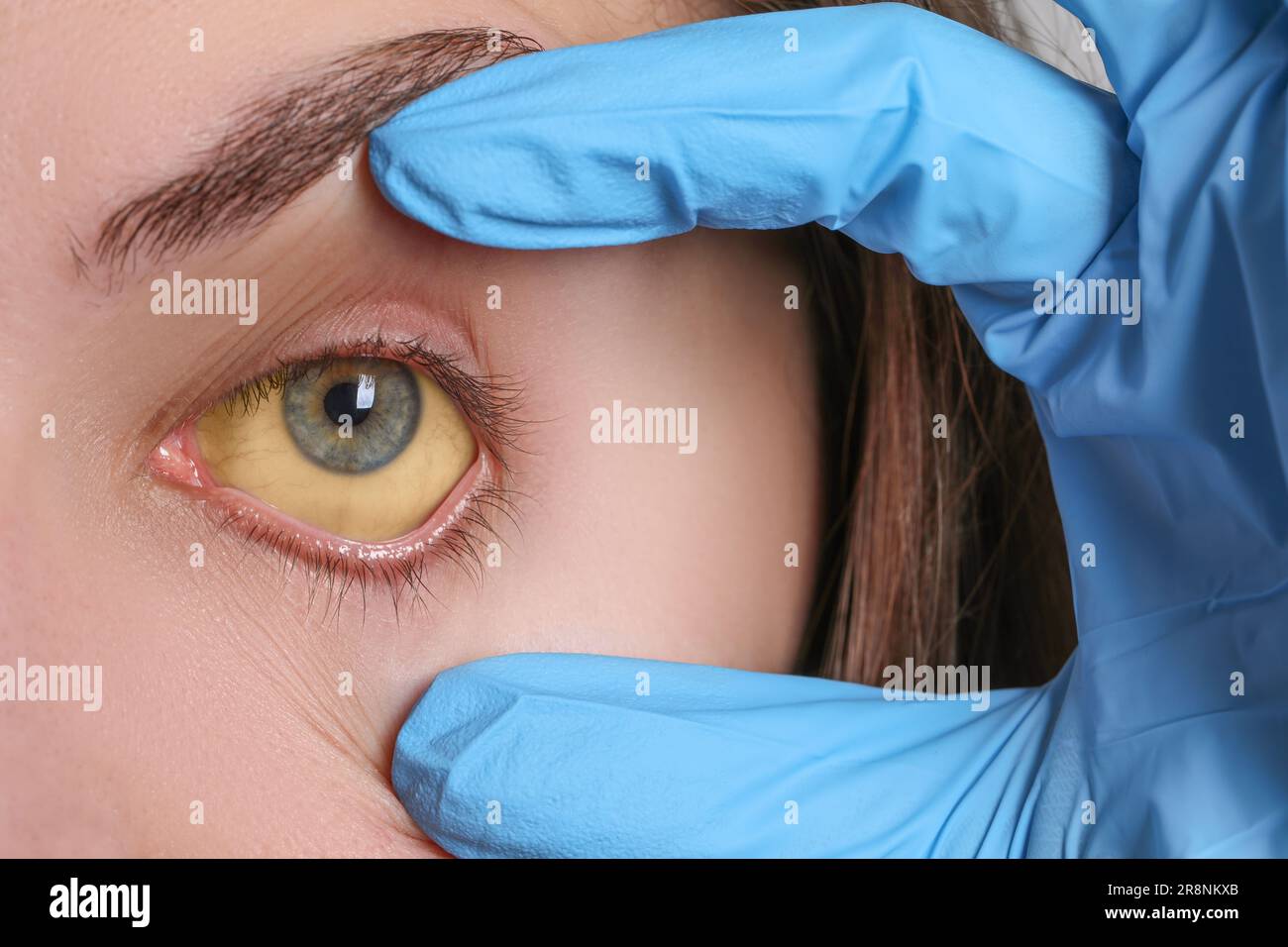 Doctor checking woman with yellow eyes, closeup. Symptom of hepatitis ...