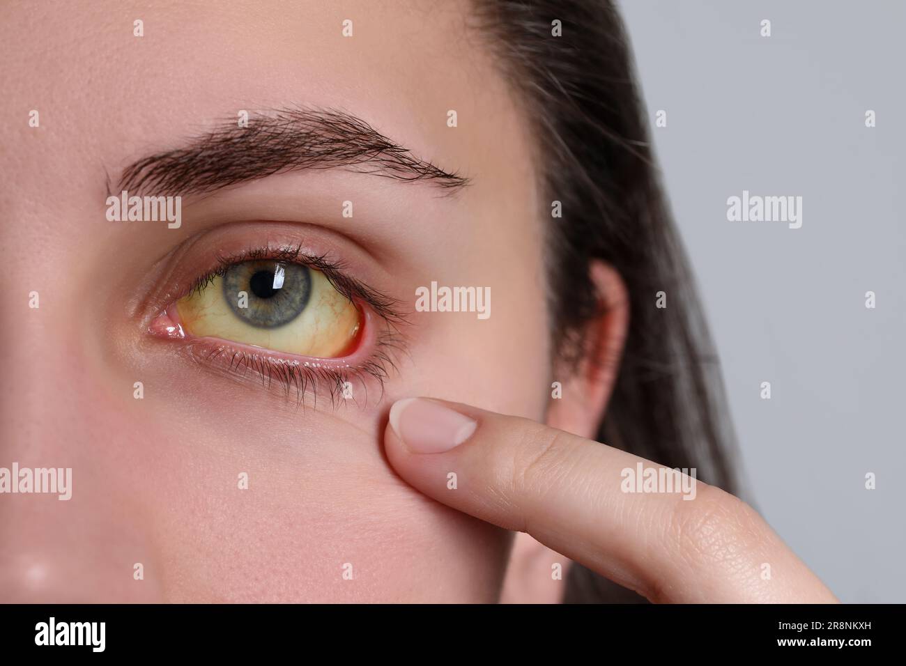 Woman with yellow eyes on light background, closeup. Symptom of ...