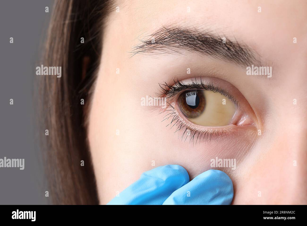 Doctor checking woman with yellow eyes on grey background, closeup ...