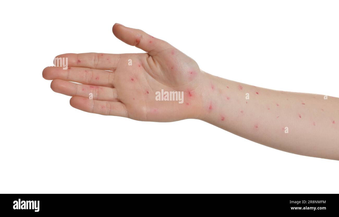 Sore spots Cut Out Stock Images & Pictures - Alamy