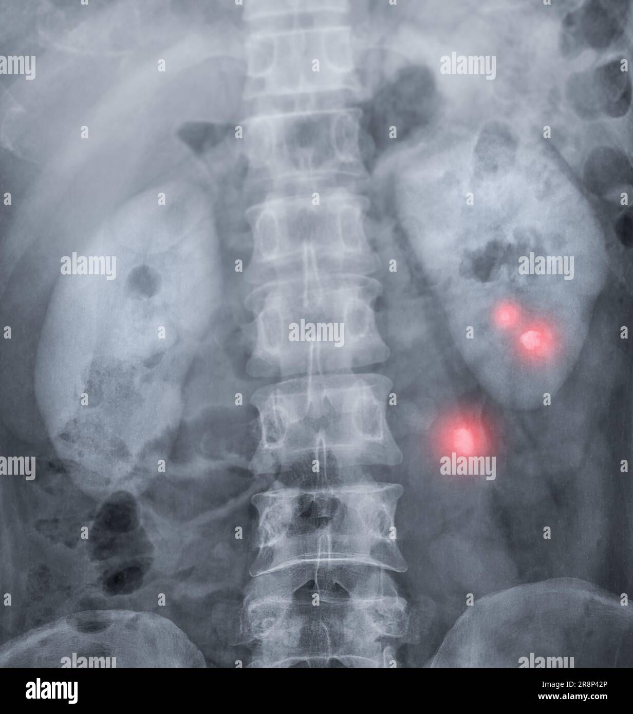 Intravenous pyelogram or I.V.P is an X-ray exam of urinary tract after ...