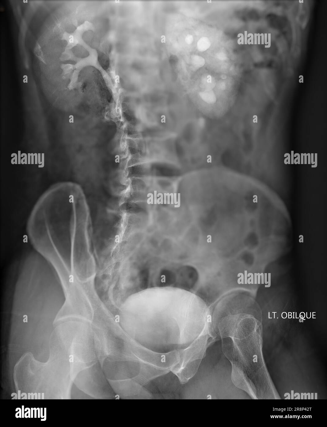 Intravenous pyelogram or I.V.P is an X-ray exam of urinary tract after ...