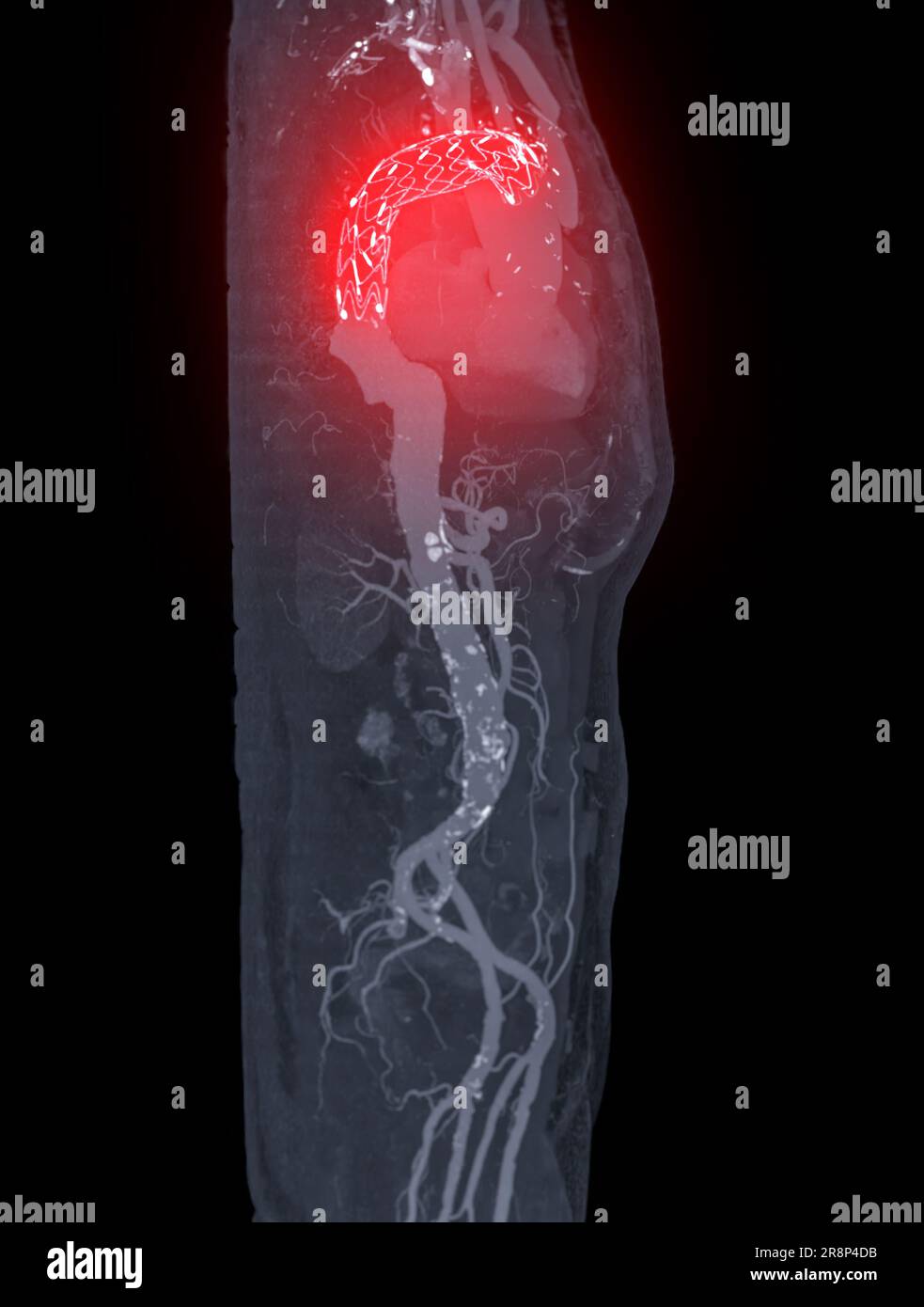 Cta Whole Aorta With Thoracic Aorta Stent Graft 3d Rendering Image In