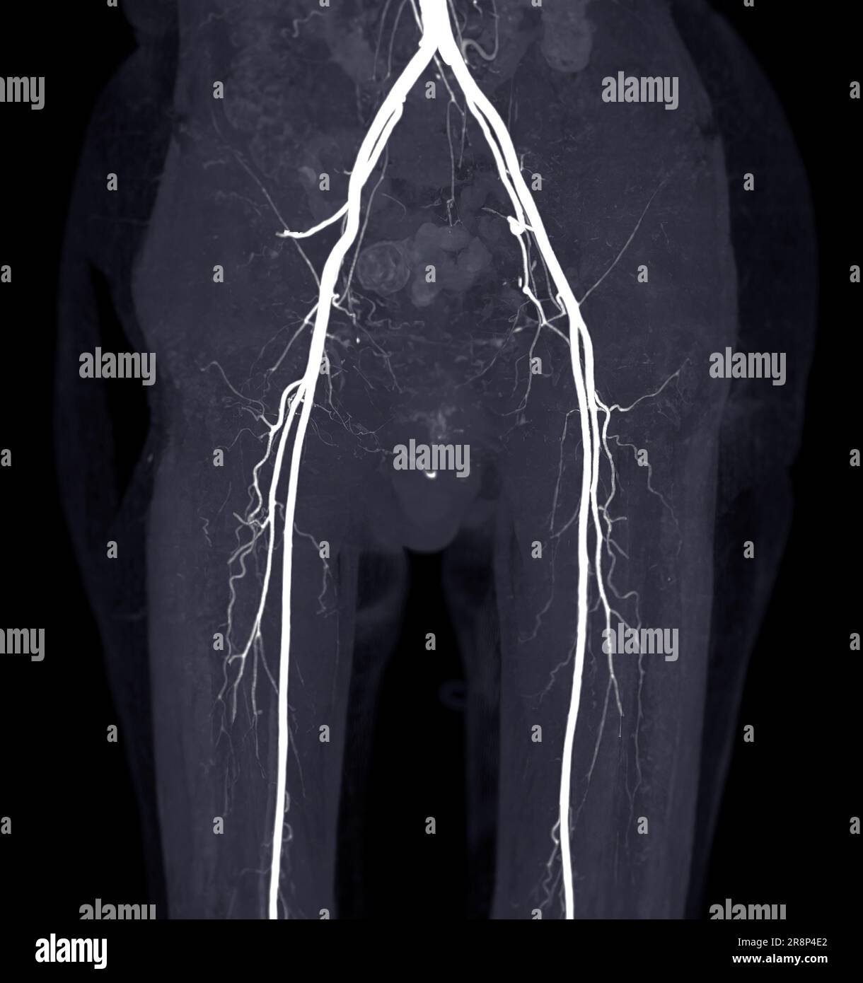 CTA femoral artery run off image of femoral artery for diagnostic Acute ...