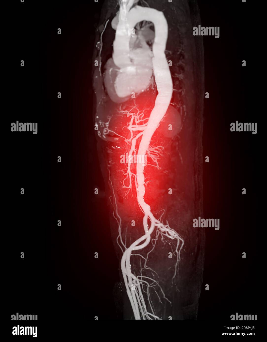 Abdominal aorta aneurysm scan hi-res stock photography and images - Alamy
