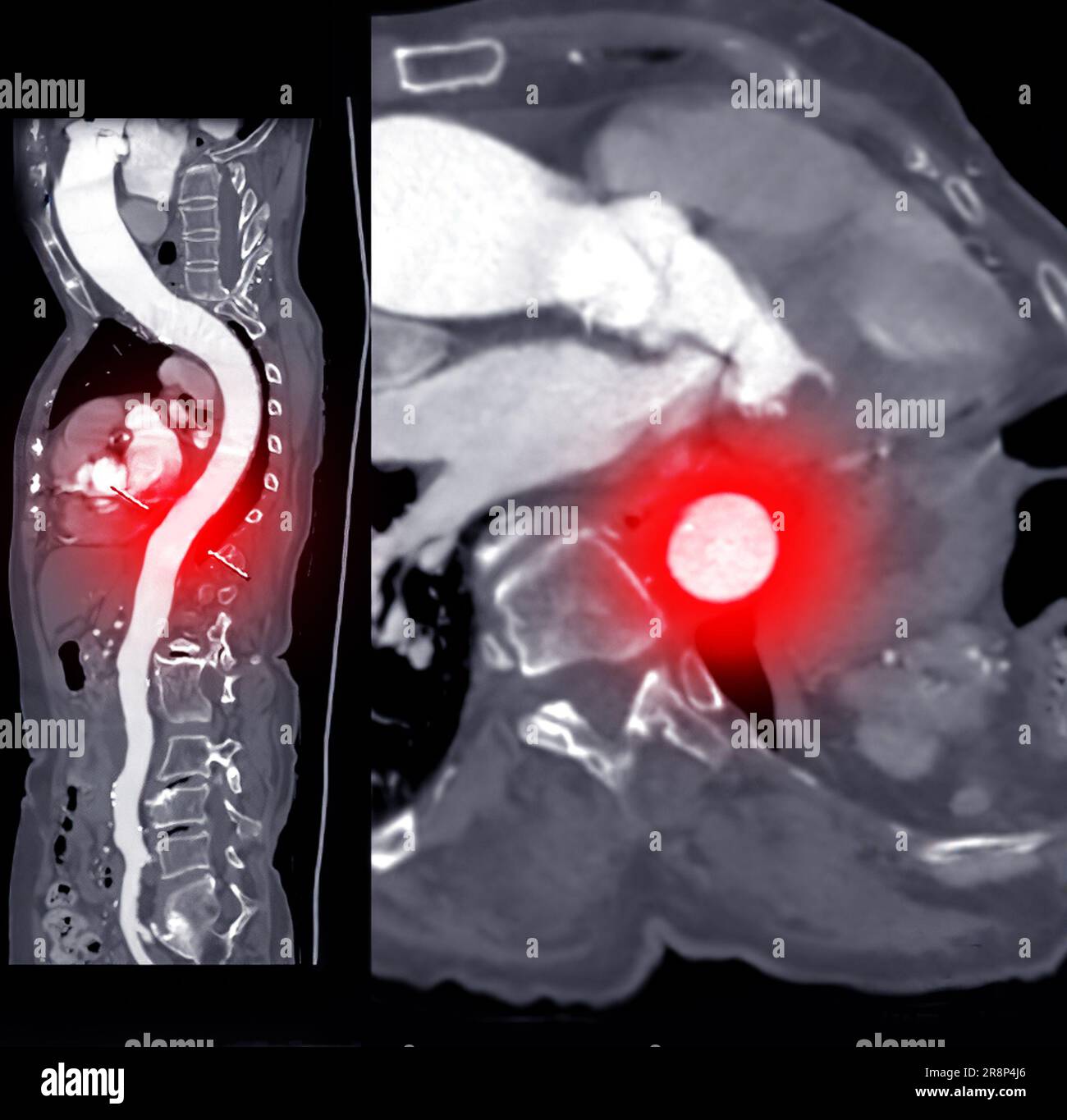 CTA whole aorta MPR Curve Stock Photo - Alamy