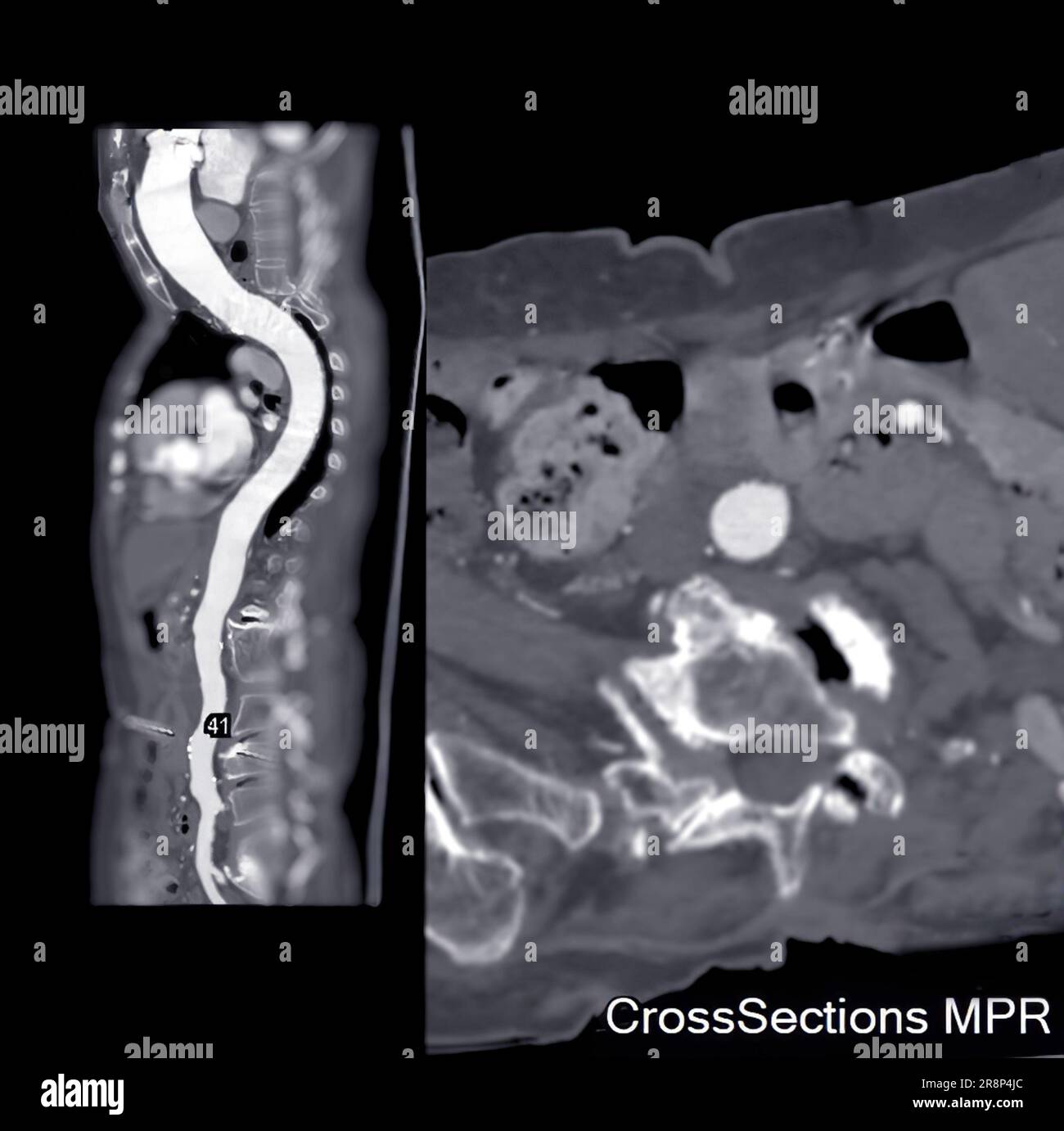 CTA whole aorta MPR Curve Stock Photo - Alamy
