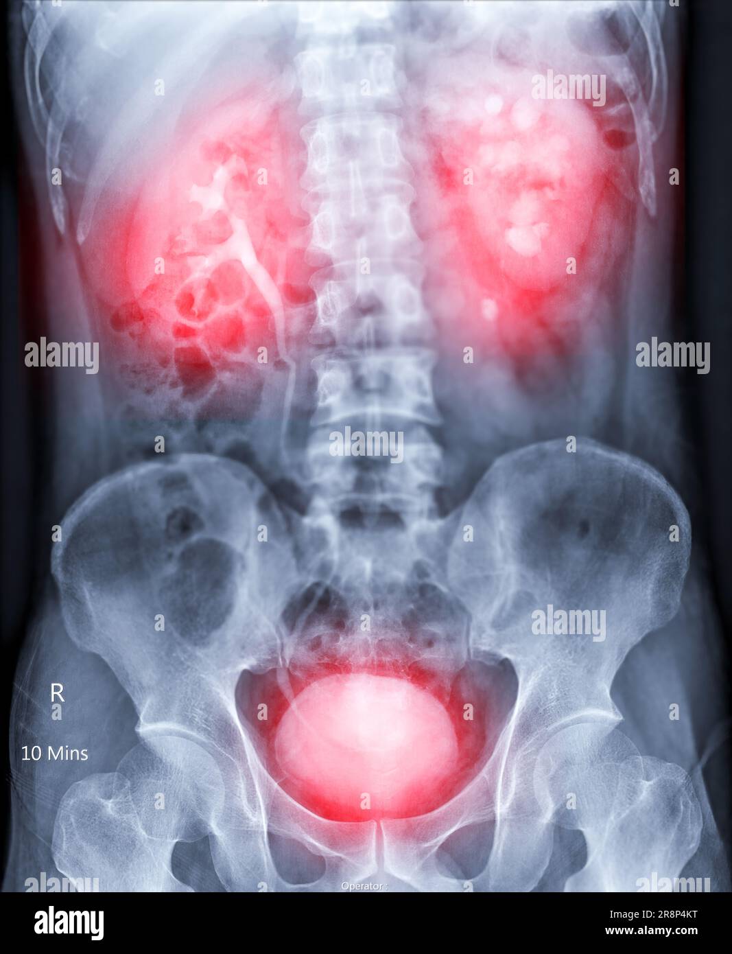 Intravenous pyelogram or I.V.P is an X-ray exam of urinary tract after ...