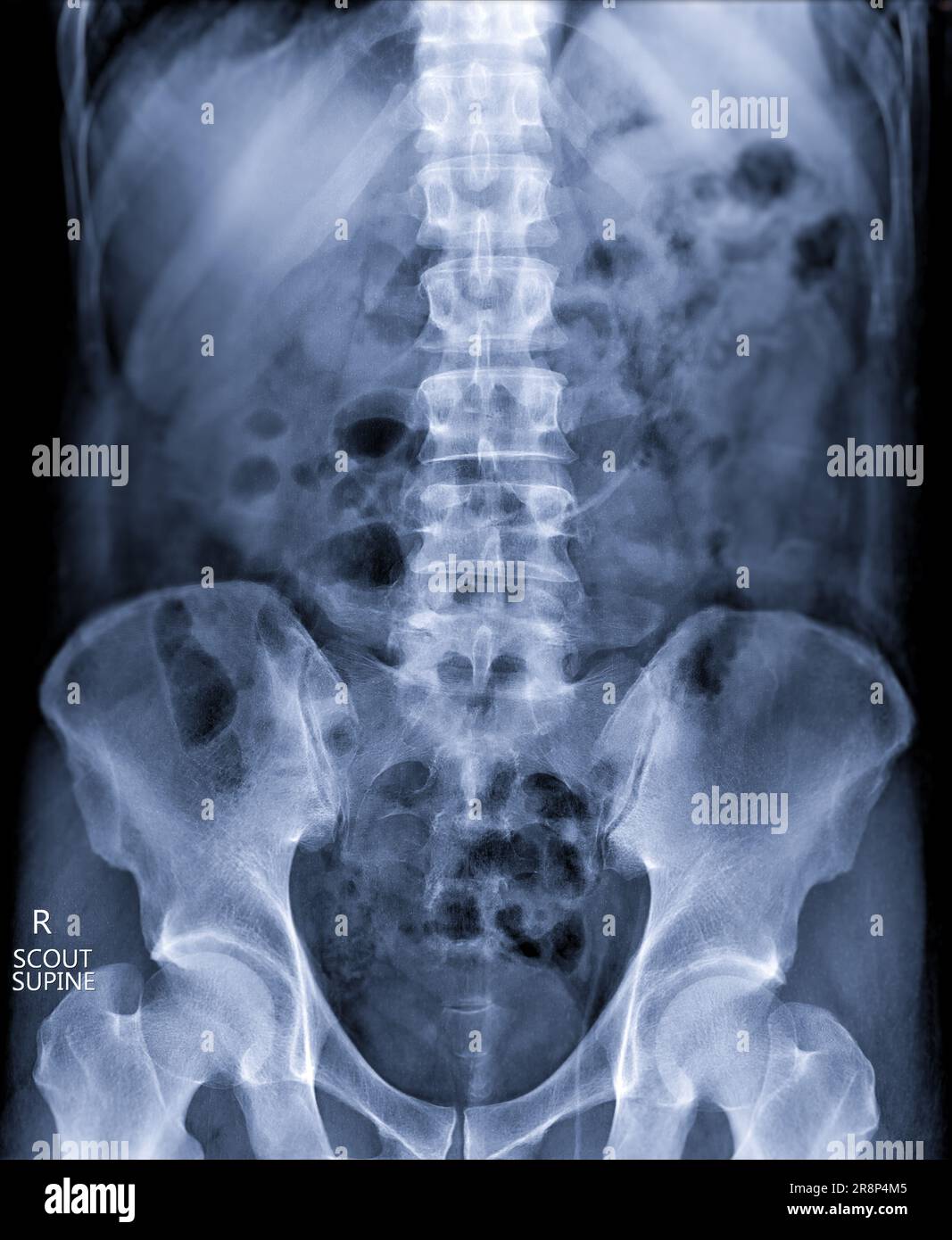 Intravenous pyelogram or I.V.P is an X-ray exam of urinary tract after ...