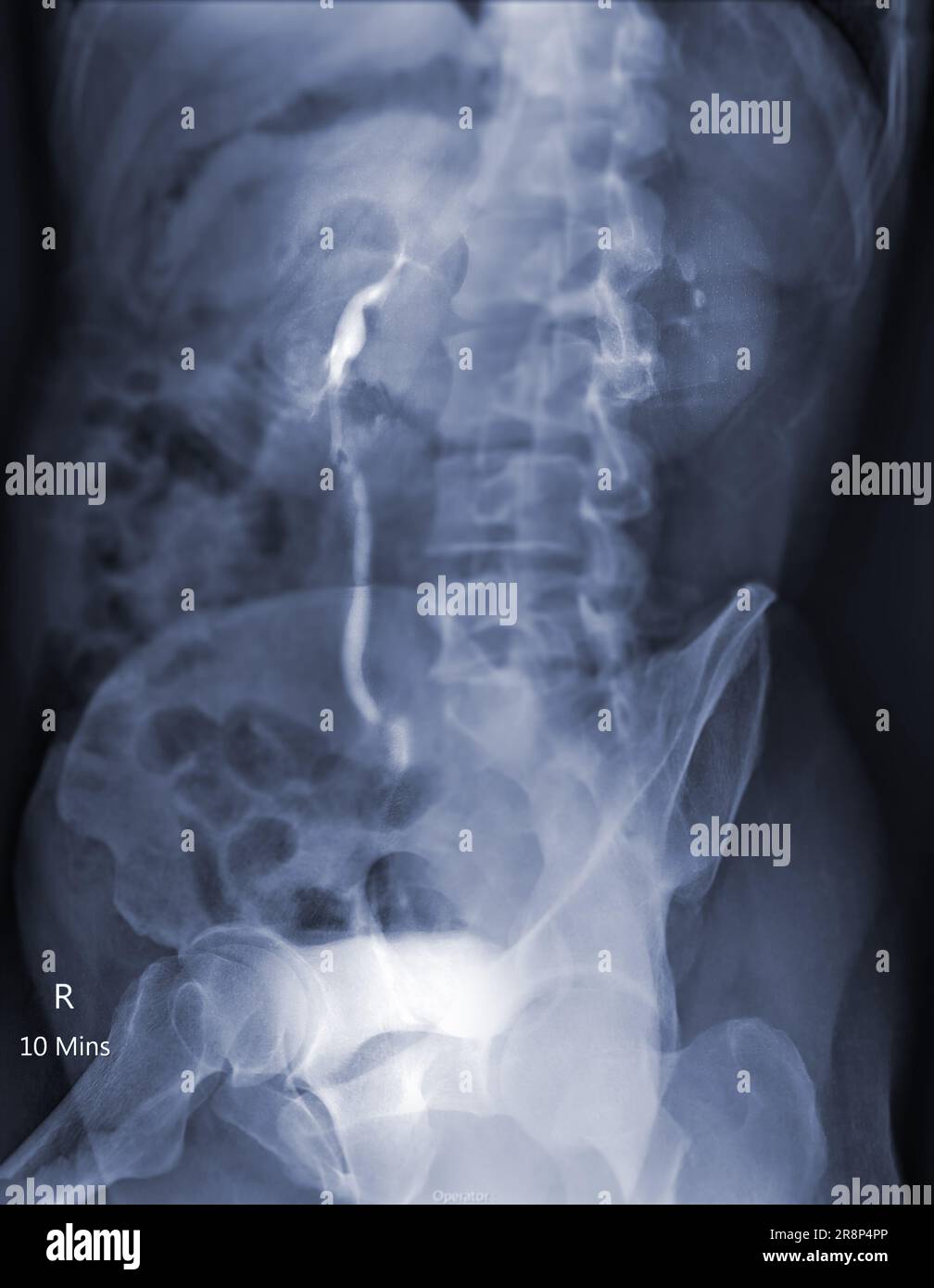 Intravenous pyelogram or I.V.P is an X-ray exam of urinary tract after ...