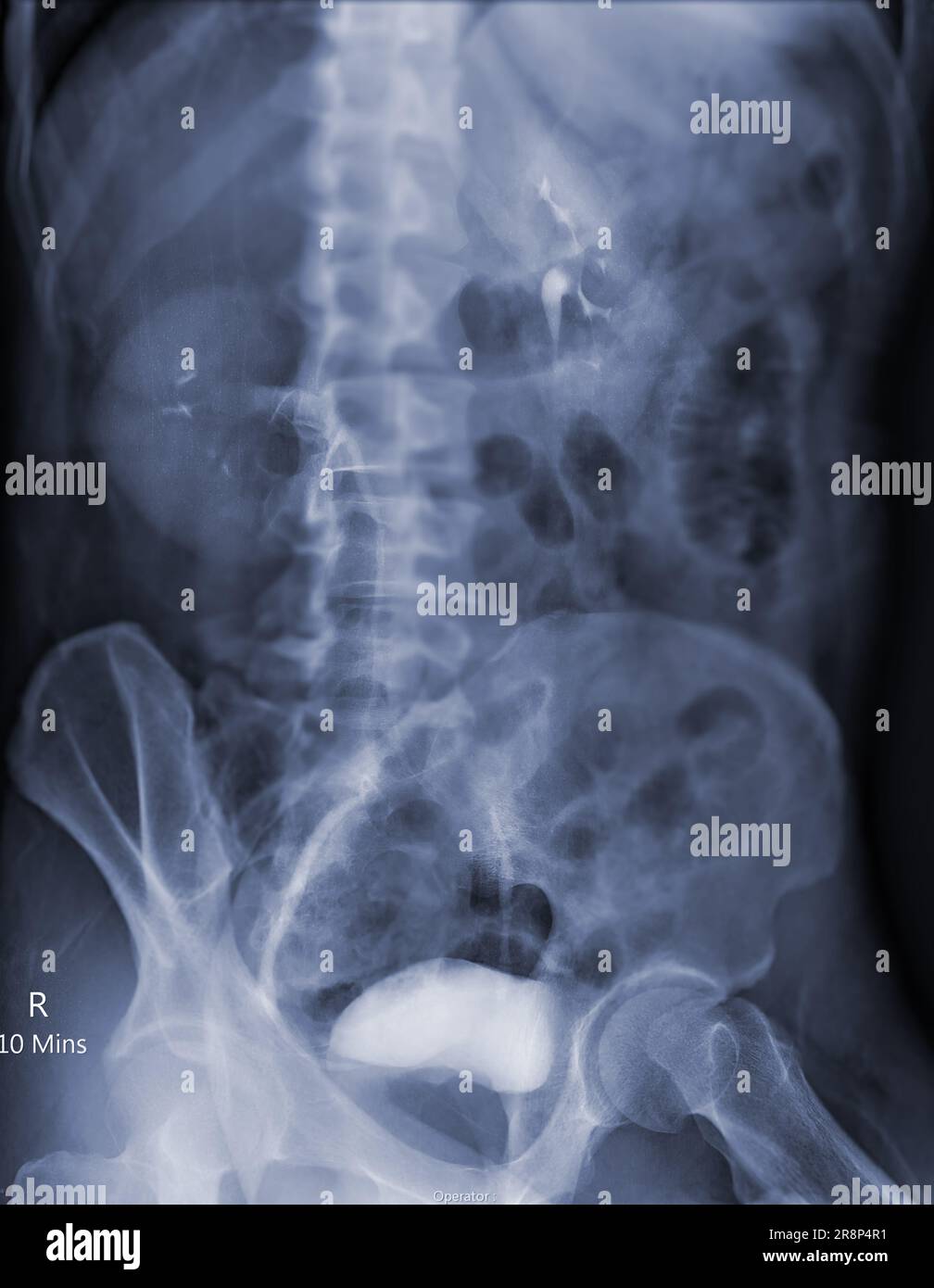 Intravenous pyelogram or I.V.P is an X-ray exam of urinary tract after ...
