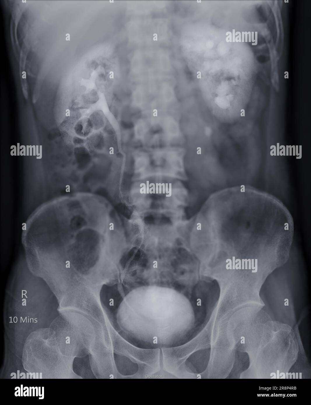 Xray Kub Intravenous Pyelogram Youtube