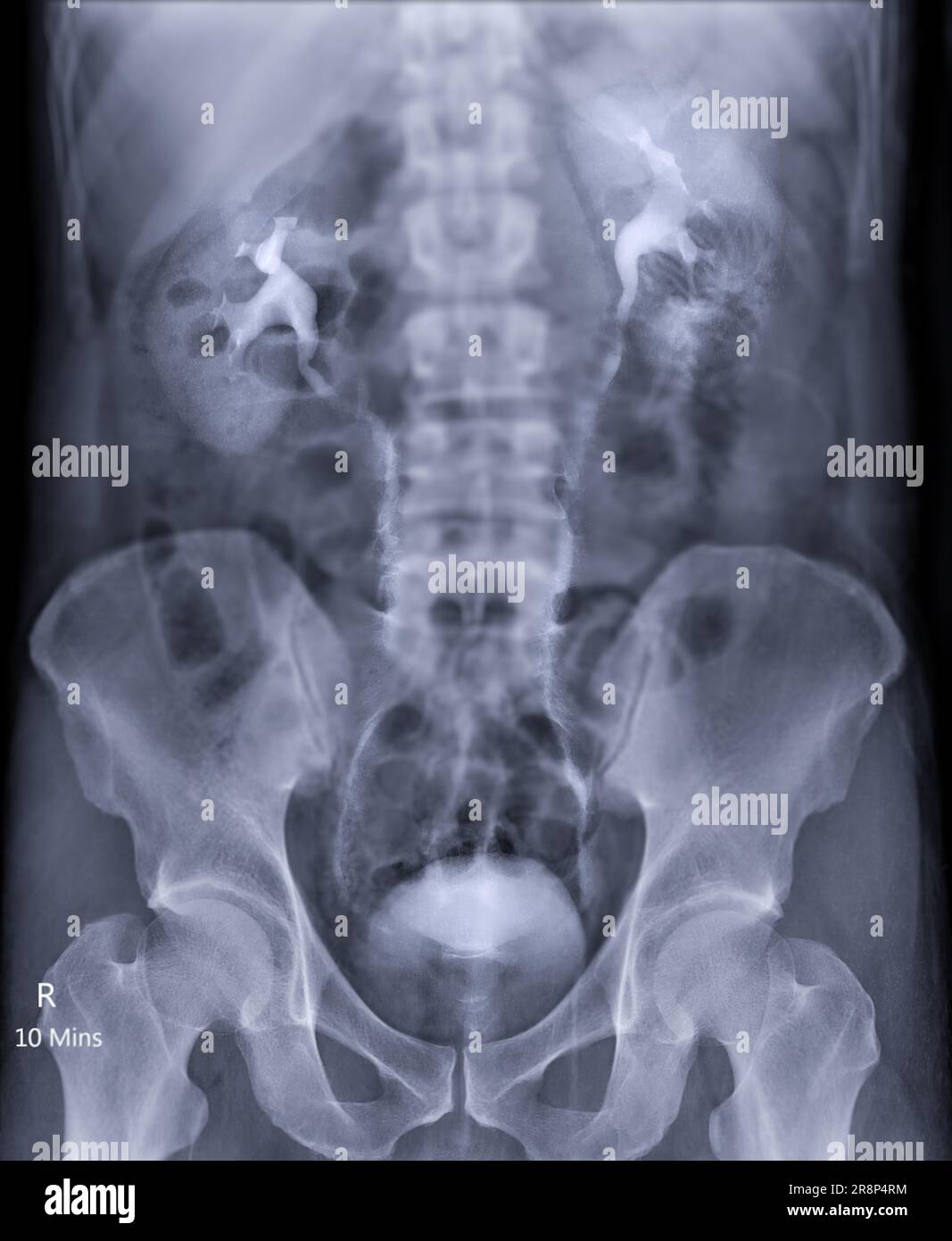 Intravenous pyelogram or I.V.P is an X-ray exam of urinary tract after ...