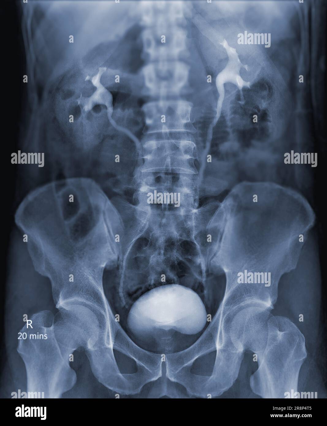 Intravenous pyelogram or I.V.P is an X-ray exam of urinary tract after ...