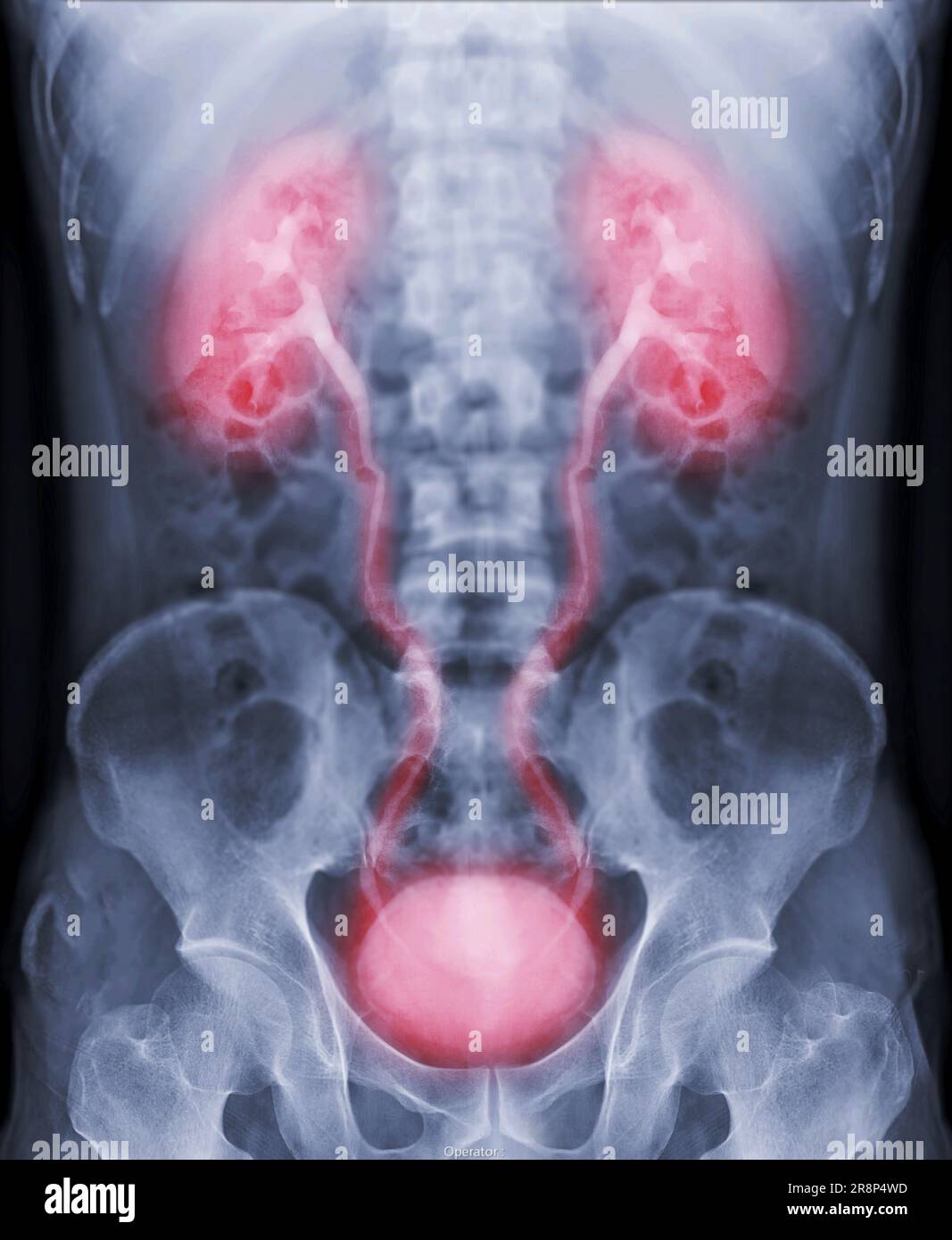 Intravenous pyelogram or I.V.P is an X-ray exam of urinary tract after ...