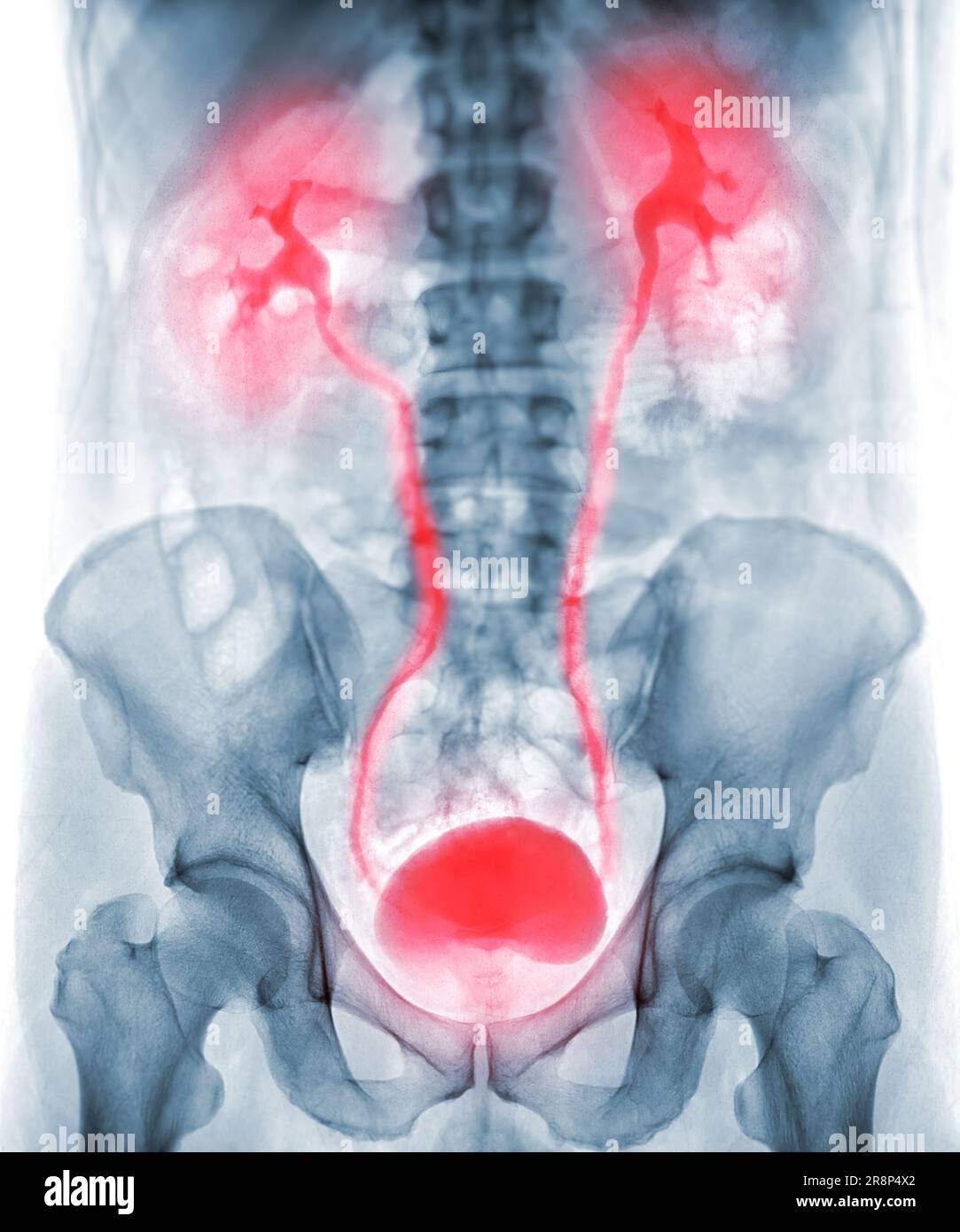 What Is An Intravenous Pyelogram Ivp
