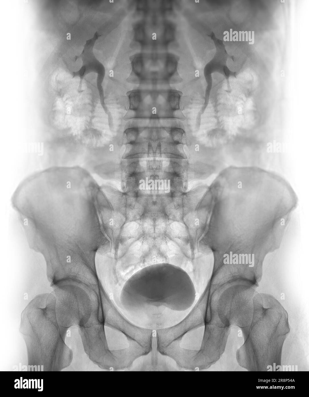 Intravenous pyelogram or I.V.P is an X-ray exam of urinary tract after ...