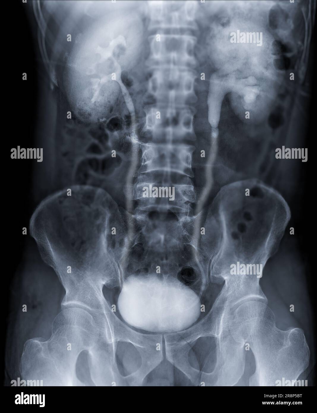 Intravenous pyelogram or I.V.P is an X-ray exam of urinary tract after ...