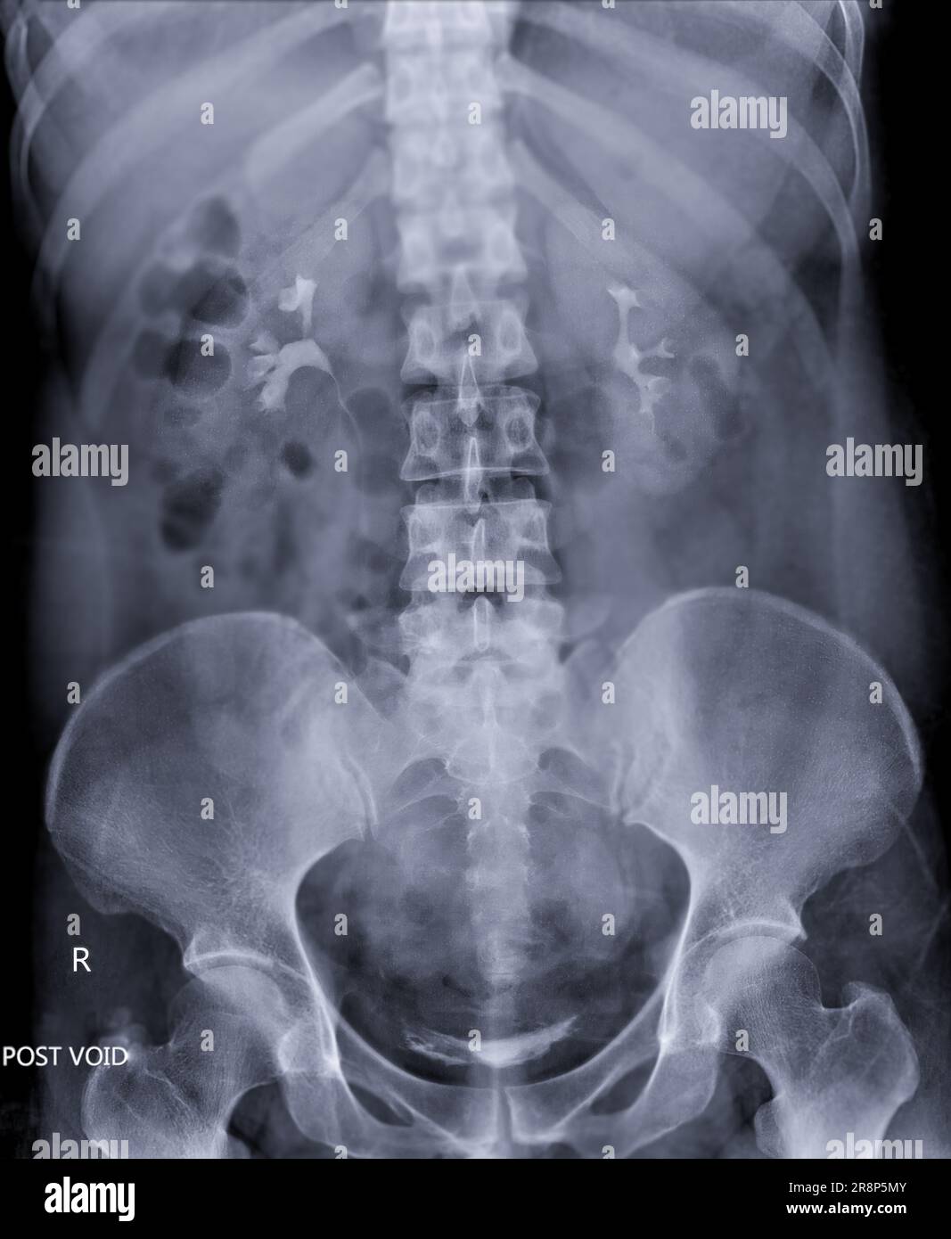 Intravenous pyelogram or I.V.P is an X-ray exam of urinary tract after ...