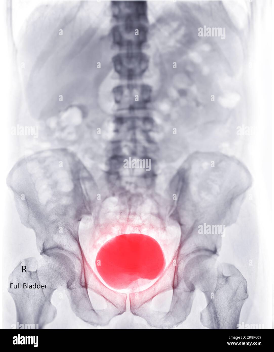 Intravenous pyelogram or I.V.P is an X-ray exam of urinary tract after ...