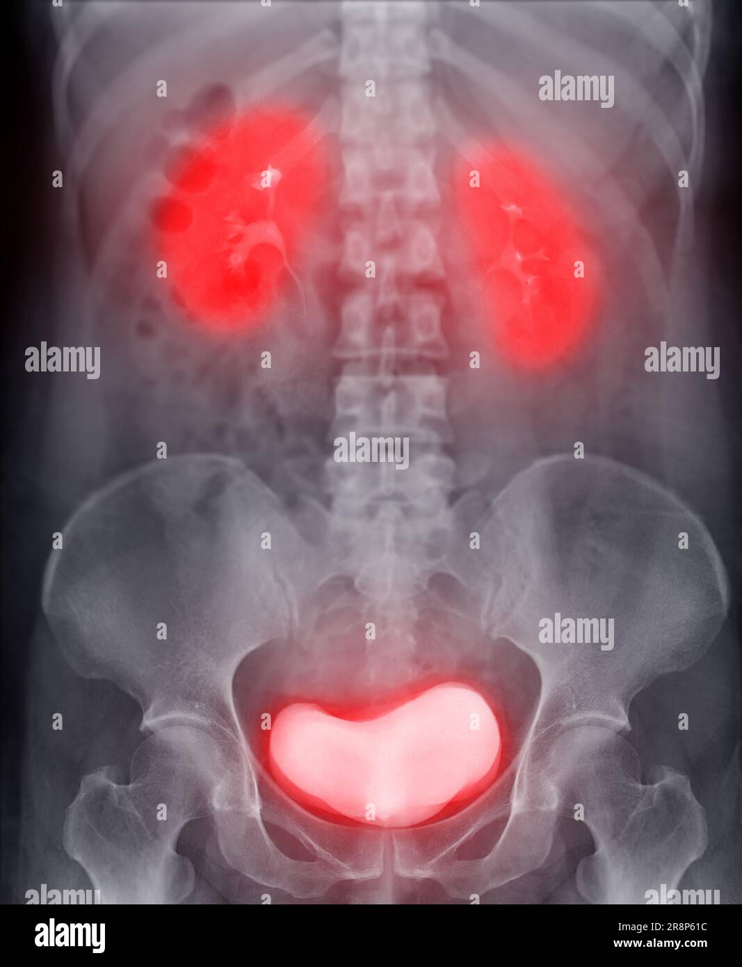 Intravenous pyelogram or I.V.P is an X-ray exam of urinary tract after ...