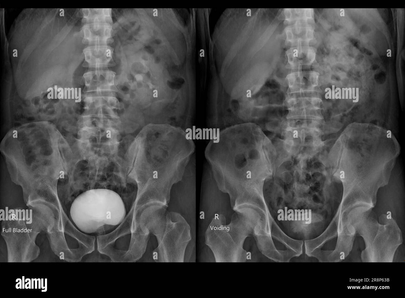 Intravenous Pyelogram Or I V P Is An X Ray Exam Of Urinary Tract After