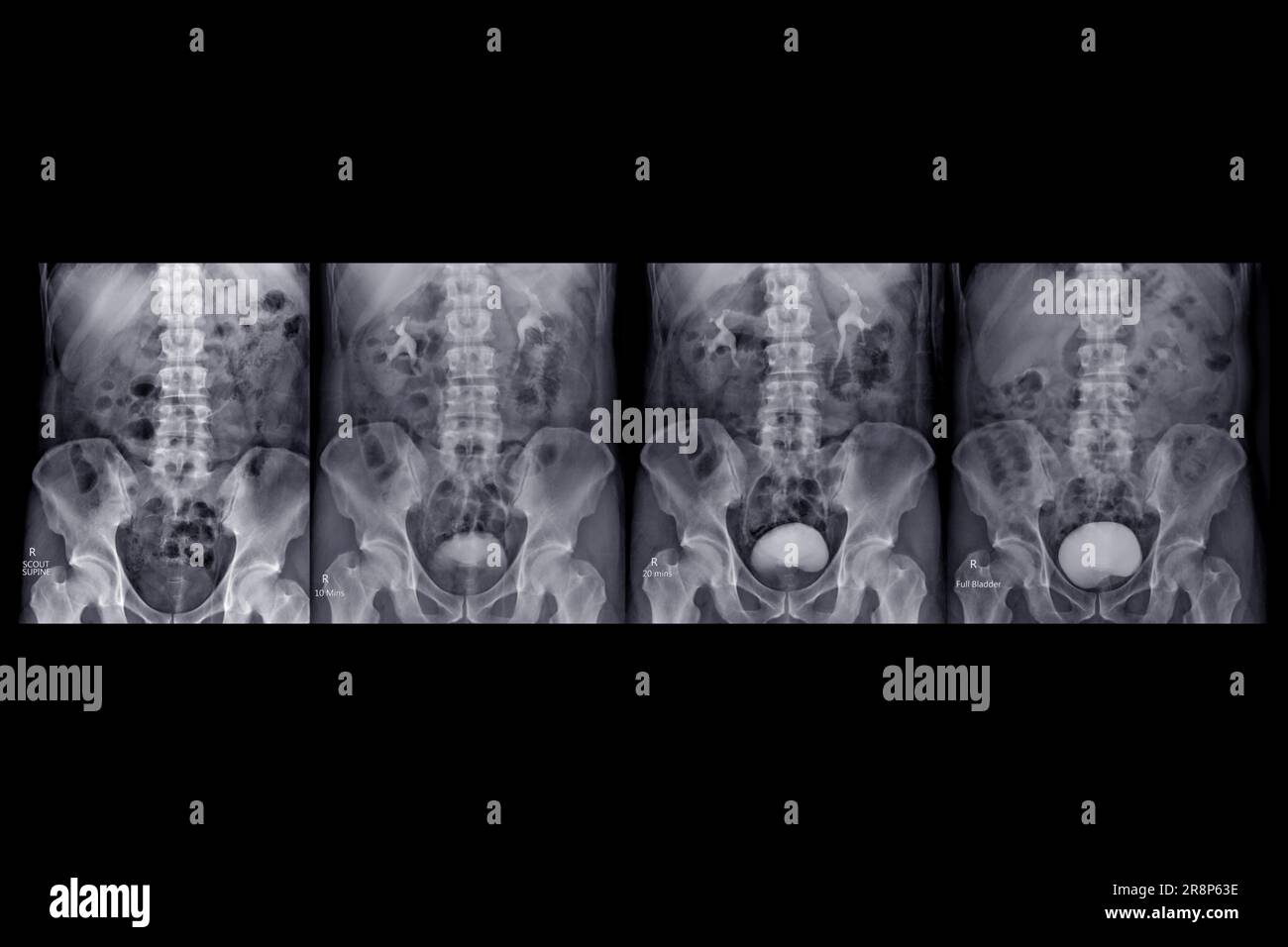 Intravenous pyelogram or I.V.P is an X-ray exam of urinary tract after ...