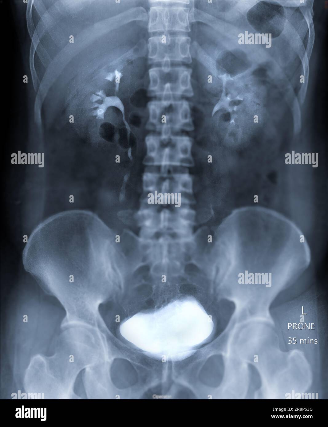 Intravenous pyelogram or I.V.P is an X-ray exam of urinary tract after ...