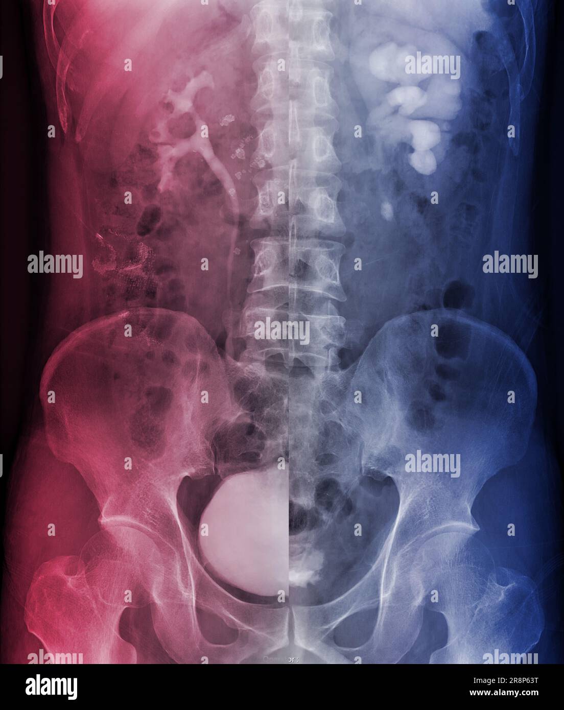 Intravenous pyelogram or I.V.P is an X-ray exam of urinary tract after ...