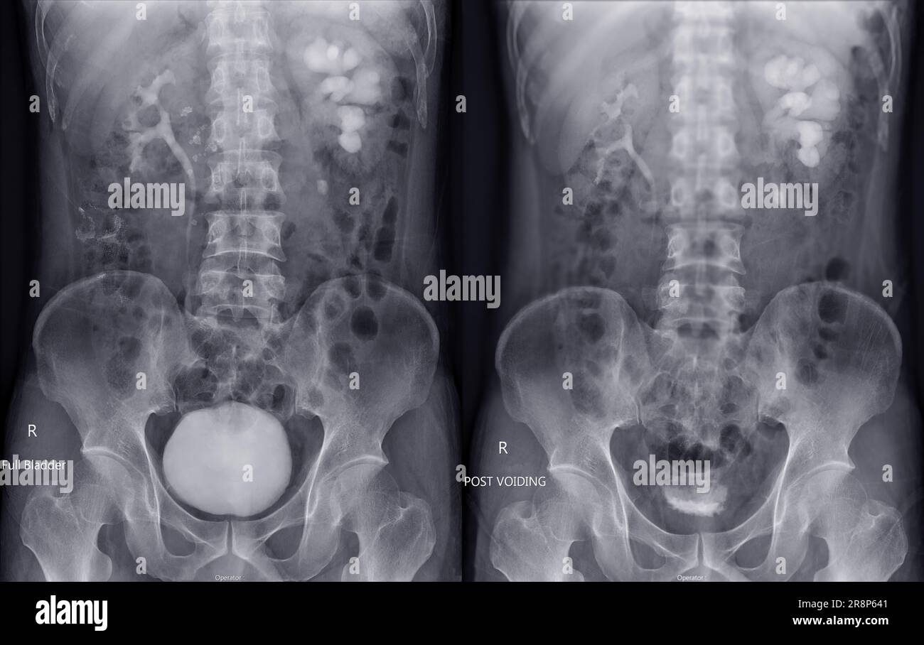 Intravenous pyelogram or I.V.P is an X-ray exam of urinary tract after ...