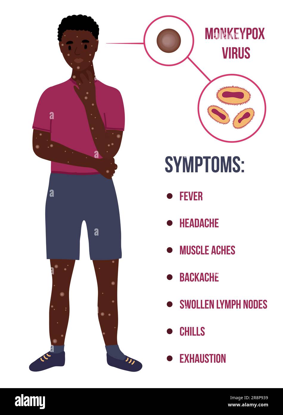 young caucasian man with many papules because of Monkey Pox virus ...
