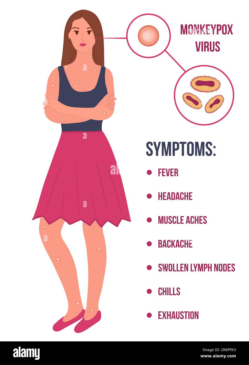 young caucasian woman with many papule because of Monkey Pox virus ...