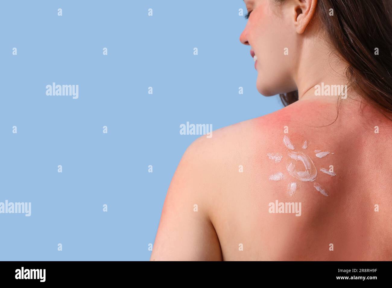 Allergic Young Woman With Sunburned Skin And Sun Made Of Cream On Blue