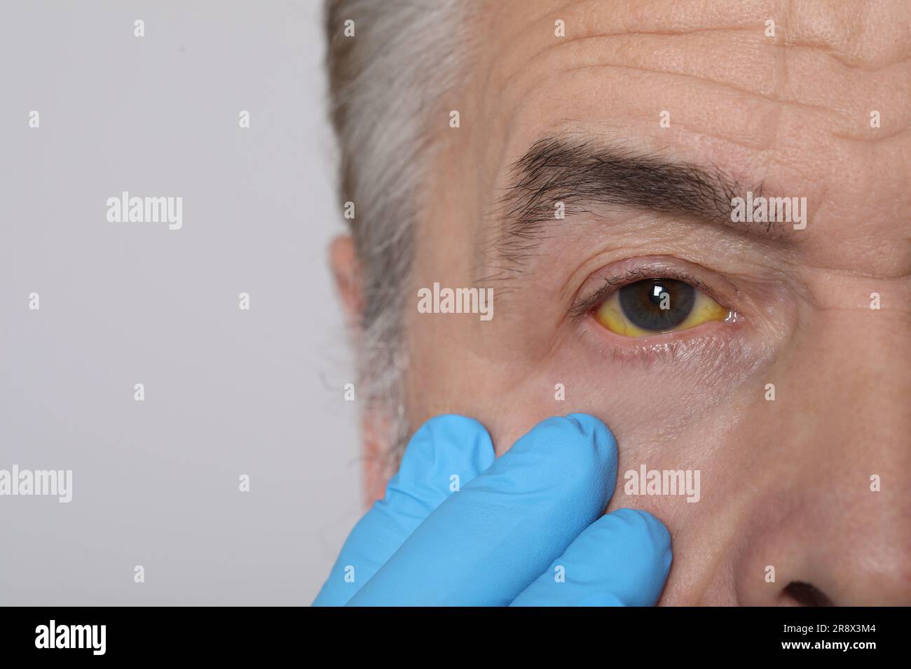 Doctor checking man with yellow eyes on light background, closeup ...